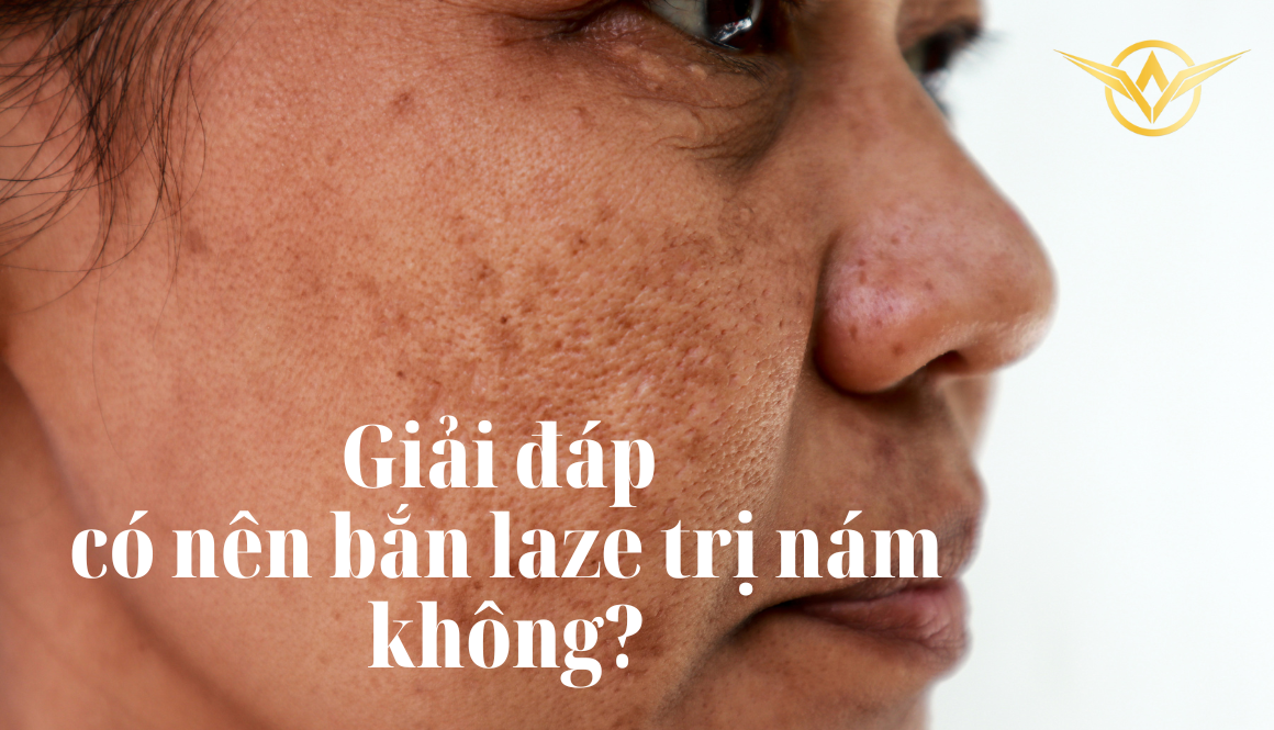 Giải đáp có nên bắn laze trị nám không? - Hanngocvananh