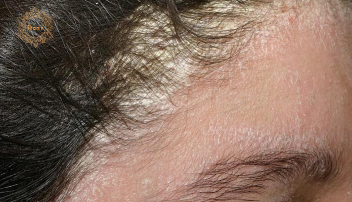 Cách trị nấm da đầu tận gốc bạn nên biết